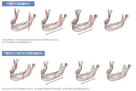 韩国一路美擅长做脸型磨骨双鄂手术轮廓风格偏华丽黑料少颌面对比照 8682整形网