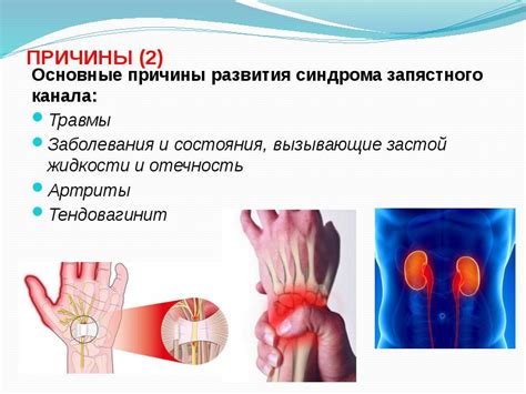 Синдром запястного канала