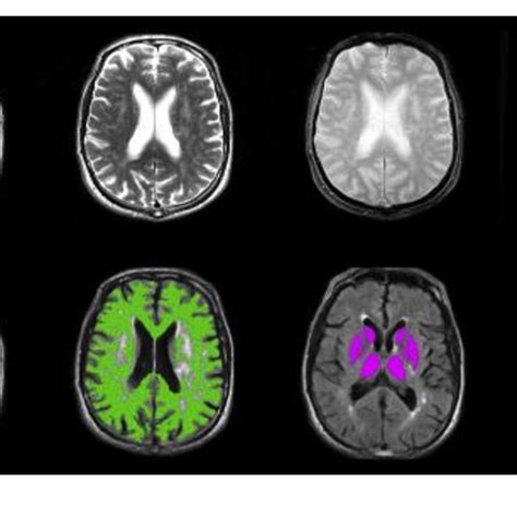 Types Of Cerebral Microbleeds A Lobar Microbleeds And B Deep Download Scientific Diagram