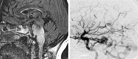 幕下硬脑膜动静脉瘘手术策略与技巧 The Neurosurgical Atlas全文翻译 脑医汇 神外资讯 神介资讯