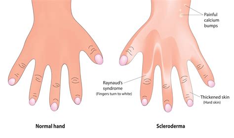 Scleroderma What Is Types Causes Symptoms And Diagnosis