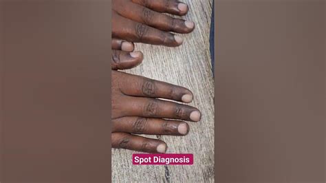 Spot Diagnosis Fingers Skin And Nail Clinical Signs And Symtoms