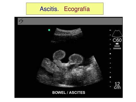 Ppt Ascitis Infección Del Líquido Ascítico Insuficiencia Renal