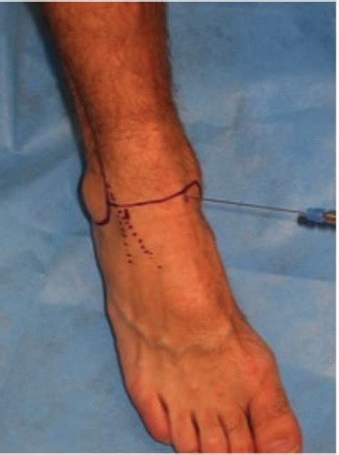 Ankle Arthroscopy Setup And Complications Musculoskeletal Key
