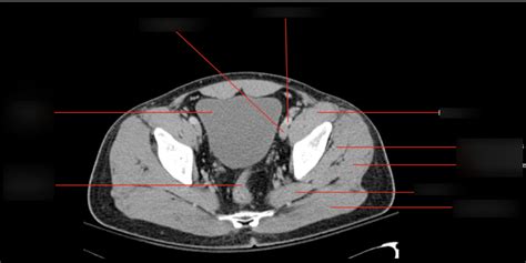 Ct Soft Tissue Axial Slice Diagram Quizlet