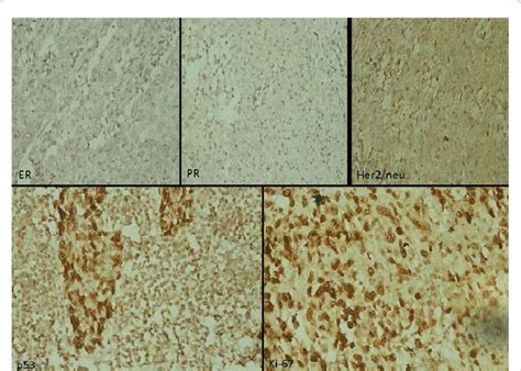 Ihc Pictures Show Negative For Er Pr And Her 2neu And Positive For