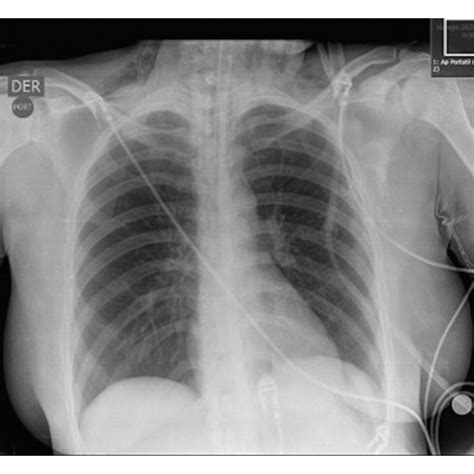 Chest X Ray Emphysema Is Observed In The Cervical Region The
