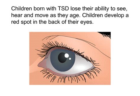 Tay Sachs Disease