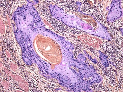 Skin Cancer Light Micrograph Stock Image F002 9237 Science Photo Library