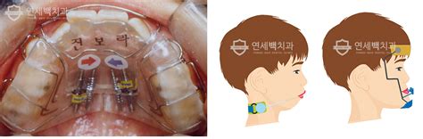 연세백치과 칼럼 치과교정치료에 대한 A ~ Z