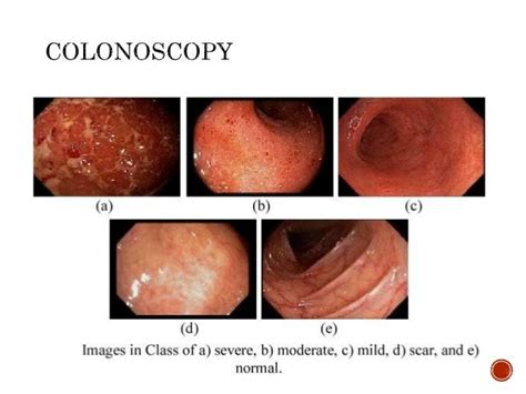 Ulcerative Colitis By Dr Ali Hasan