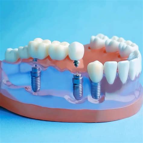 Famosos Con Implantes Dentales