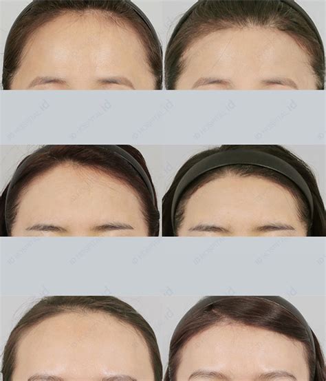 Idhospital Idhospitalkorea Plasticsurgery Koreanplasticsurgery Surgeryinkorea