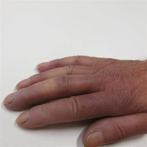 Acrocyanosis In A 74 Year Old Female With A Herniated Disk Of The