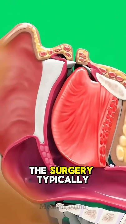 Tonsillectomy Surgery Explained 🔬 Step By Step Tonsil Removal Procedure” Youtube