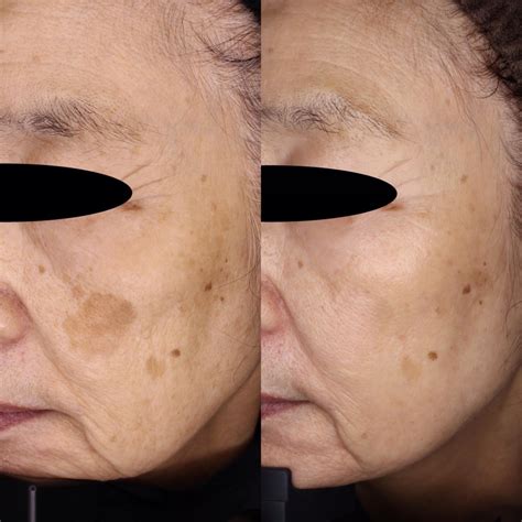 患者様症例 70代女性 いちみや皮フ科クリニック