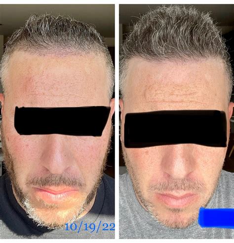Fue Transplant 6 Month Results Dr Carlos Wesley Nyc Hair Transplant