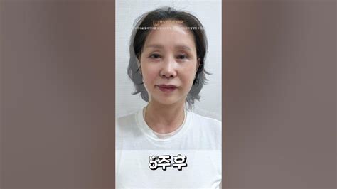 우리엄마가 우리언니가 된 사연🤷‍♀️ 안면거상 이마거상 중안면거상 코수술 윤곽수술 후기🎇 Youtube