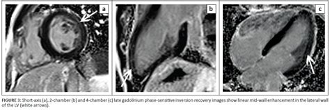 Review Of Cardiovascular Magnetic Resonance In Human Immunodeficiency Virus Associated