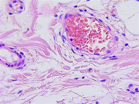 New Classification System Proposed For Colorectal Cancer