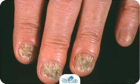 قارچ پوستی چیست؟ انواع، علت بهترین درمان‌های خانگی و پزشکی