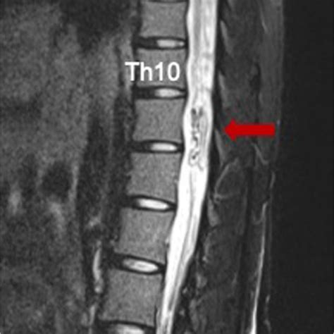 Magnetic Resonance Imaging T2 Weighted Image In The Thoracic Level At