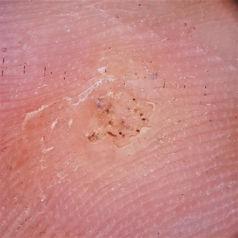 Dermoscopy Flat Wart On The Face Size 2x3 Mm Single Dotted And