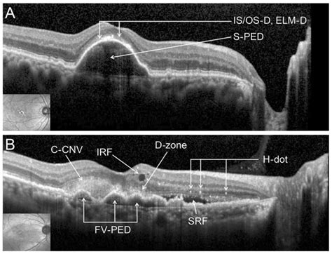spectral domain optical coherence tomography images a is os d