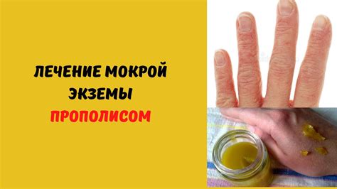 Рецепт от мокнущей экземы рук из прополиса White Out 21st Tape