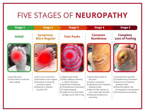 5 Stages Of Neuropathy Pdf