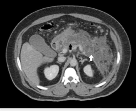Acute Necrotic Pancreatitis With Approximately 90 Pancreatic