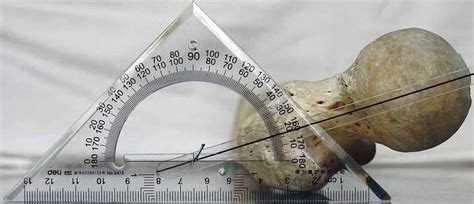 Measuring Femoral Torsion Angle Download Scientific Diagram