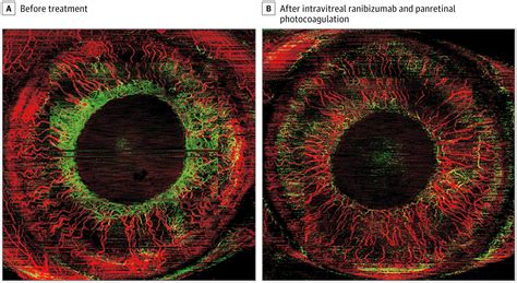 Anterior Segment Optical Coherence Tomography Angiography Of Iris Neovascularization After