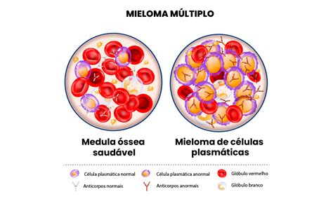 Tratamentos Para Mieloma M Ltiplo Vence Onco