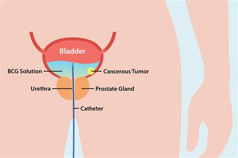 Bcg Therapy Benefits And What To Expect