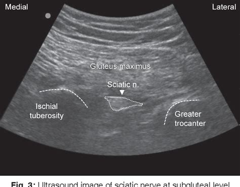Figure 5 From Ultrasound Guided Approaches To Sciatic Nerve Block