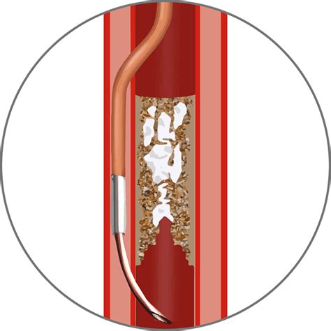 Beback Crossing Catheter Cook Medical