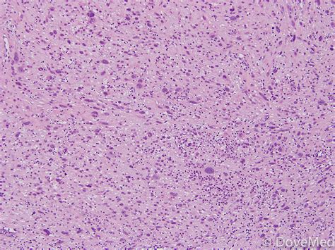 Synovial Sarcoma Of Heart