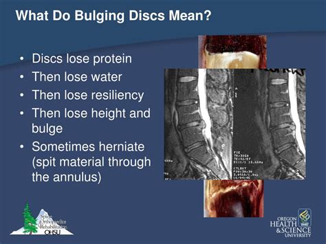 Ppt Treating Bulging Discs And Sciatica Powerpoint Presentation Id235135
