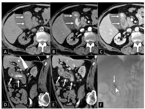 Computed Tomography Insights On Gi Bleeding Nine Takeaways From New