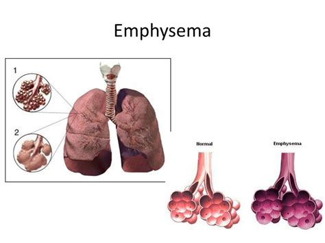Does Emphysema Emphysema Understanding Symptoms Causes And