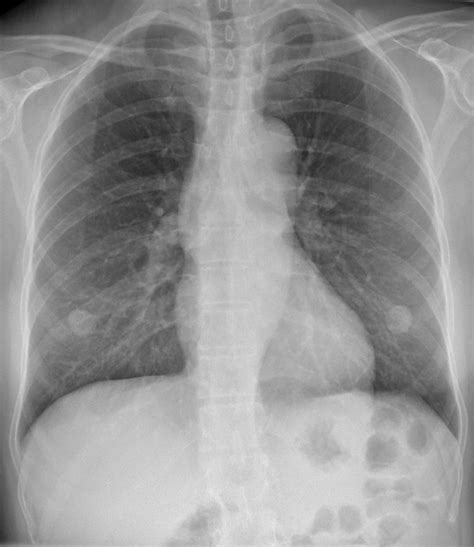 Routine Chest X Ray View At Marcia Reames Blog