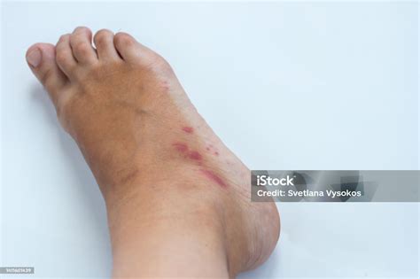 Infectious Disease Of The Legs Foot Fungus And Allergic Rash Stock