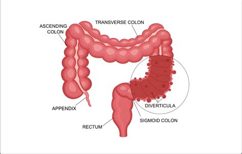 Diverticulitis Vector Illustration Labeled Medical Diagram 59 Off