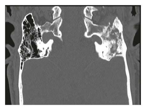 High Resolution CT Scan Coronal Cut Of The Temporal Bone Total Download Scientific Diagram