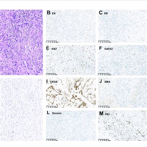Pathological Examination Showed Spindle Cell Morphology A Hande Download Scientific Diagram