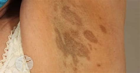 Acquired Dermal Macular Hyperpigmentation Image