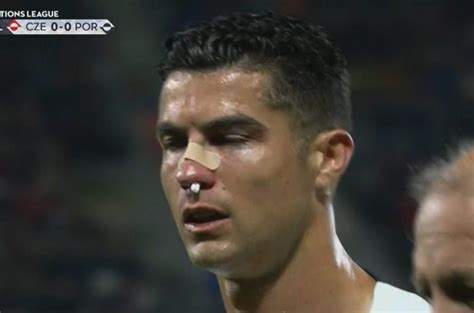 Cristiano Ronaldo Tumefatto Dopo Uno Scontro Durissimo Si Ritrova A