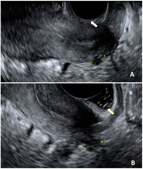 Ultrasonographic Image Of A Die Nodule Affecting Uterosacral Ligament
