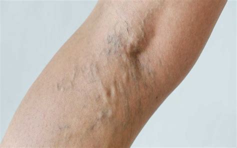 Natural Remedies For Bulging Veins A Holistic Approach